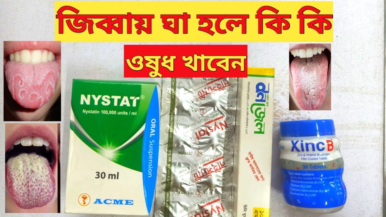 জিব্বায় ঘা হলে কি কি ওষুধ খাবেন। Nystat drop - YouTube
