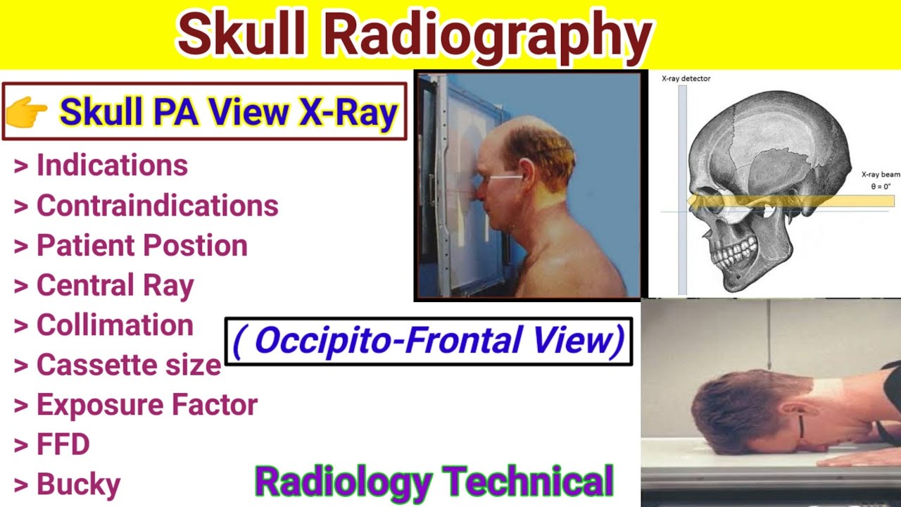 Skull Radiography # Skull PA view x-ray positioning # Occipito-frontal ...