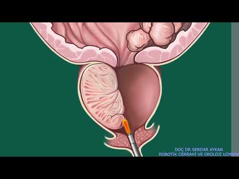 HOLEP- THULEP OPERASYONU NEDİR? LAZER PROSTAT AMELİYATI. DOÇ DR SERDAR AYKAN