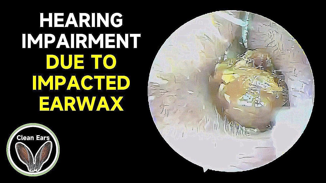 HEARING IMPAIRMENT DUE TO IMPACTED EARWAX - YouTube