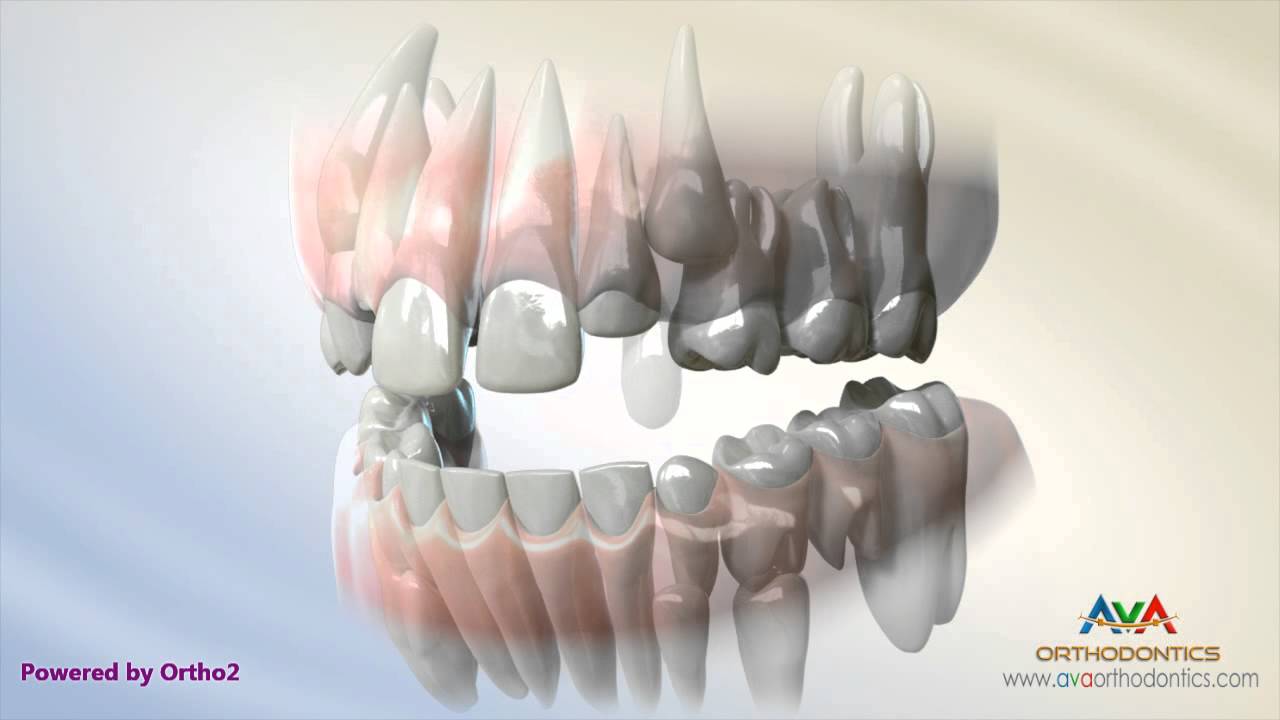 Malocclusion - Shift in Dental Midline - YouTube