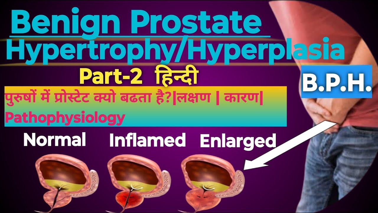 B.P.H.|Pathophysiology|Sign & Symptoms| Treatment |Benign prostate ...