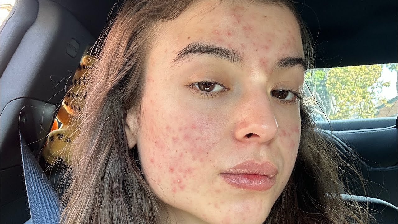 The REAL and Unfiltered reason behind my acne - YouTube