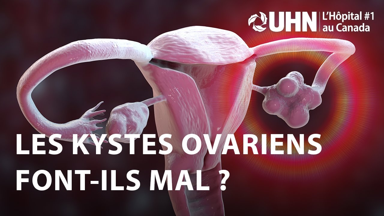 L'UHN Explique : Kystes de l'ovaire | UHN Explains: Ovarian Csyts - YouTube