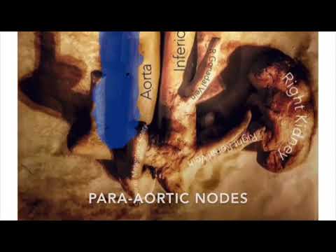 RPLND for prostate cancer - narrated - YouTube