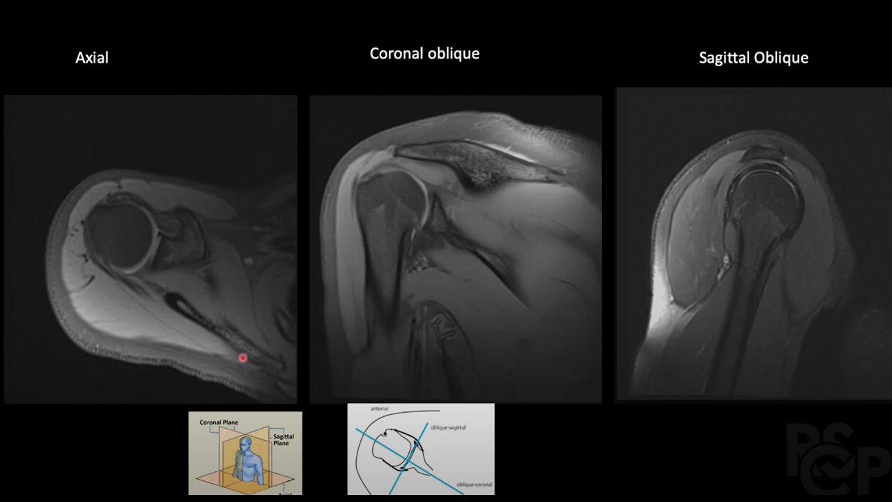MRI Shoulder - Anatomy Review - YouTube