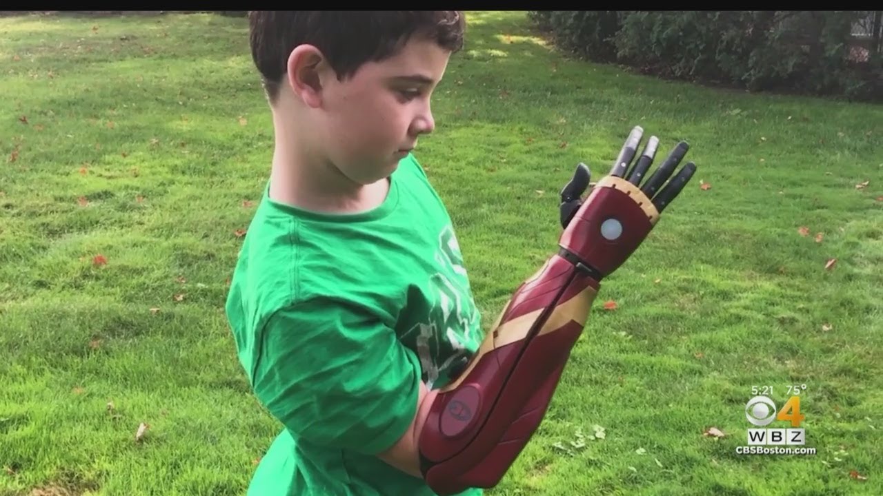 Lynnfield Boy's New Bionic Arm Channels Iron Man - YouTube