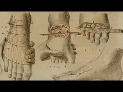 U.S. Civil War Amputations - YouTube