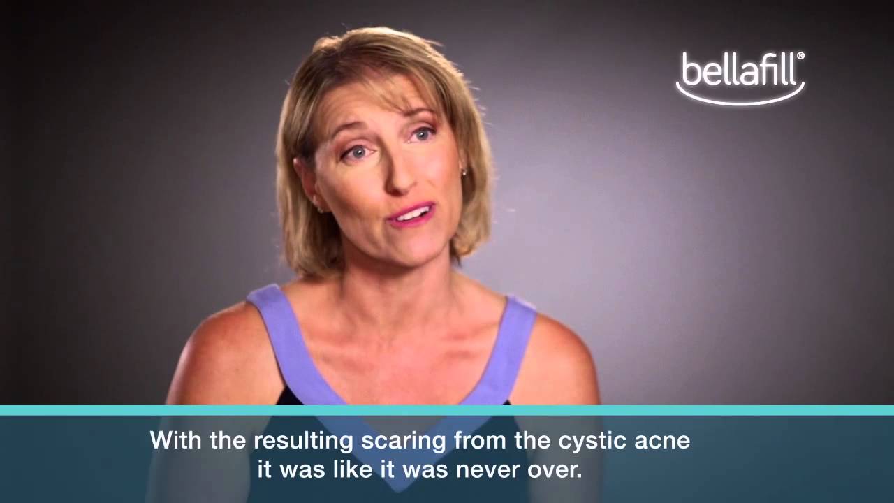 Bellafill® Acne Scar Patient Testimonials - YouTube