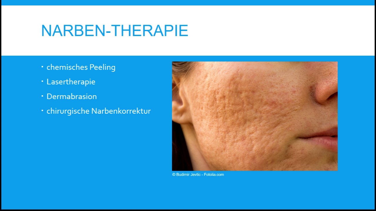 Akne vulgaris (Pickel), Papeln, Pusteln, Mitesser und Co. - YouTube