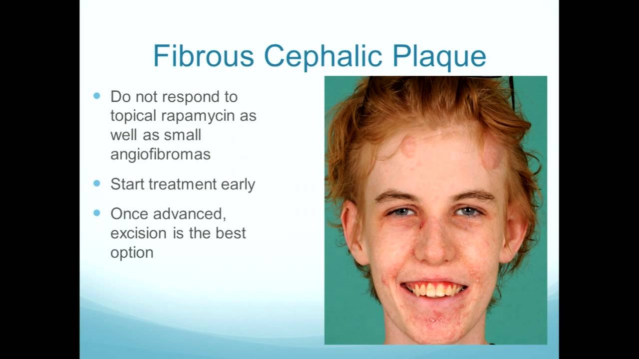 Managing the signs of TSC on the skin - Dr Anne Halbert - YouTube