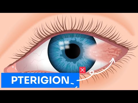 Conoce sobre PTERIGION : causas y tratamiento ! - YouTube
