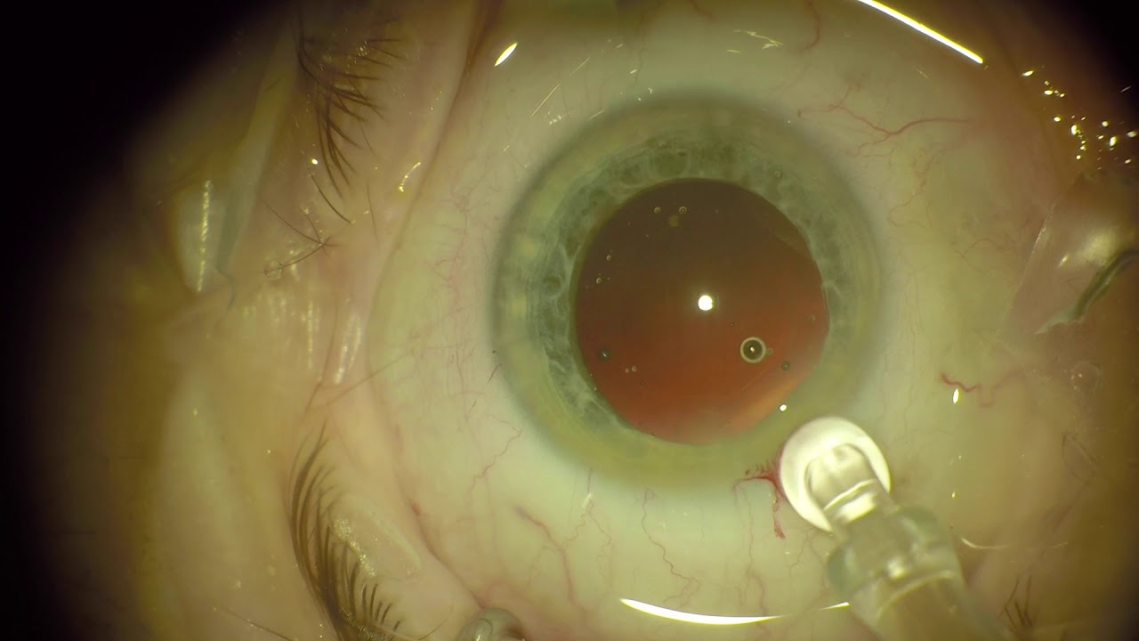 Alcon Clareon AutonoMe - YouTube