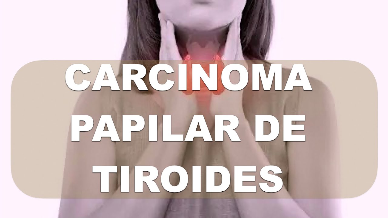 Carcinoma papilar de Tiroides. Explicación completa - YouTube