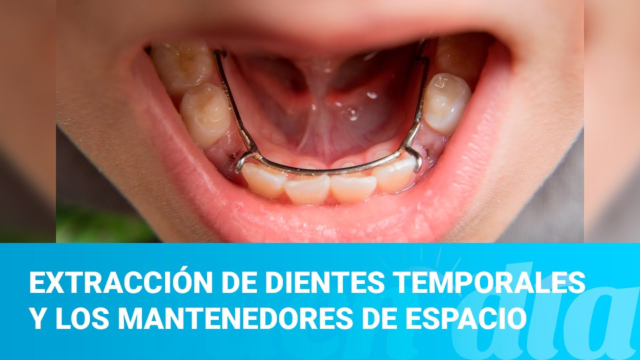 Extracción de dientes temporales y los mantenedores de espacio - YouTube
