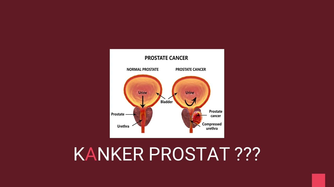 Kanker Prostat (Definisi, Etiologi, Patofisiologi, Diagnosis, dan ...