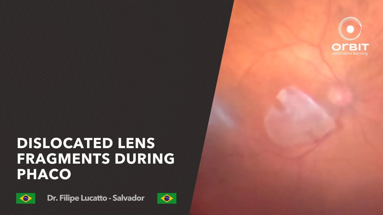 Dislocated lens fragments during phaco - YouTube