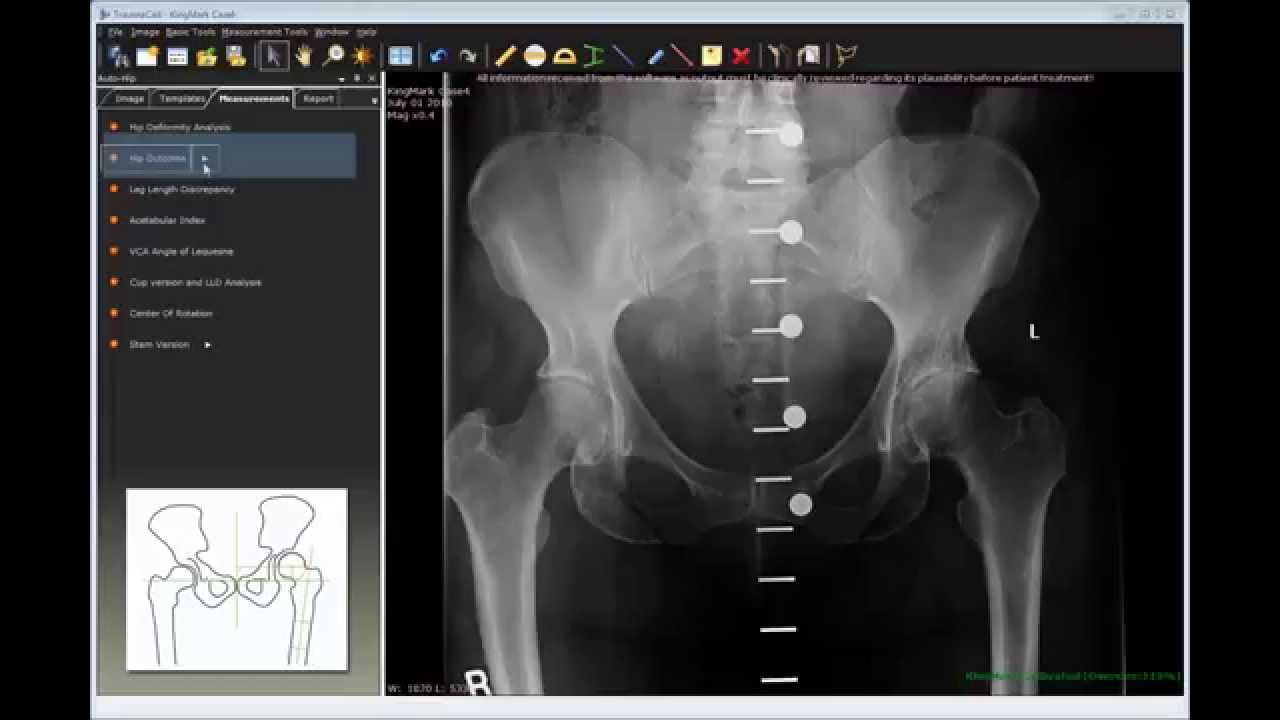 Using TraumaCad's Hip Outcome Tool - YouTube