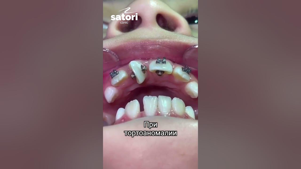 Цепочки для брекетов, чейны - YouTube