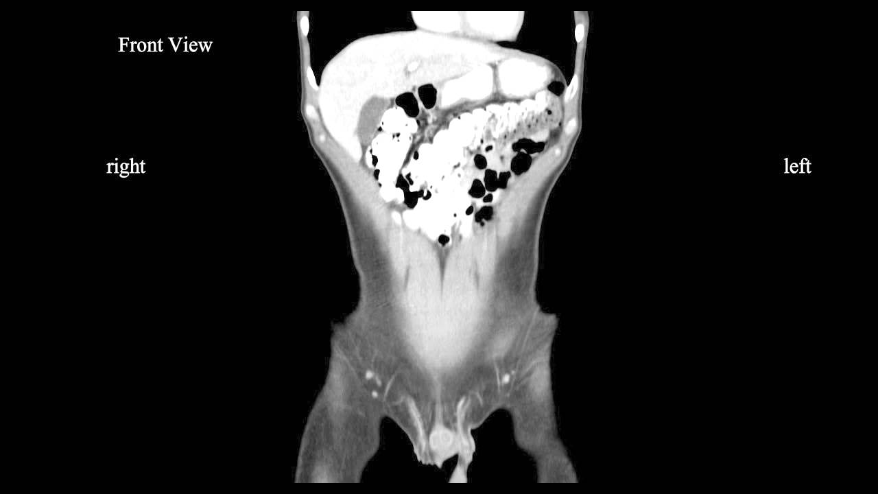 Abdominal CT Scan, what's wrong? - YouTube