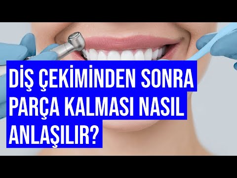 Diş Çekiminden Sonra Parça Kalması Nasıl Anlaşılır?