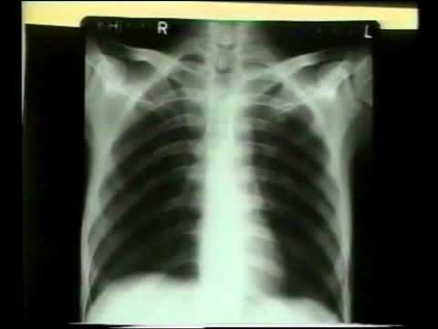 1. How to read a Chest X-Ray - Dr. Vaidya - YouTube