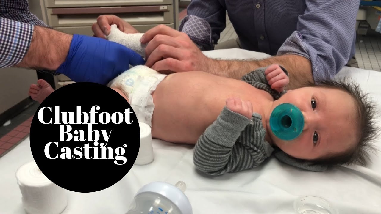 CLUBFOOT BABY GETS NEW CAST| WHAT TO EXPECT - YouTube
