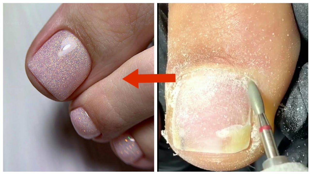 Most Satisfying Pedicure Transformation 😱 best nail polish for toes ...