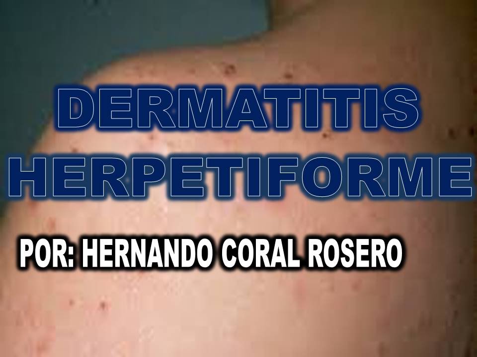 DERMATITIS HERPETIFORME ( ERUPCIÓN DE LA PIEL ) - YouTube