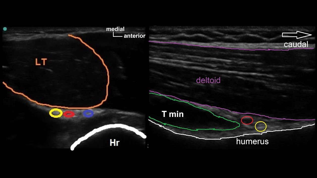 Axillary nerve block: supine and lateral approaches - YouTube
