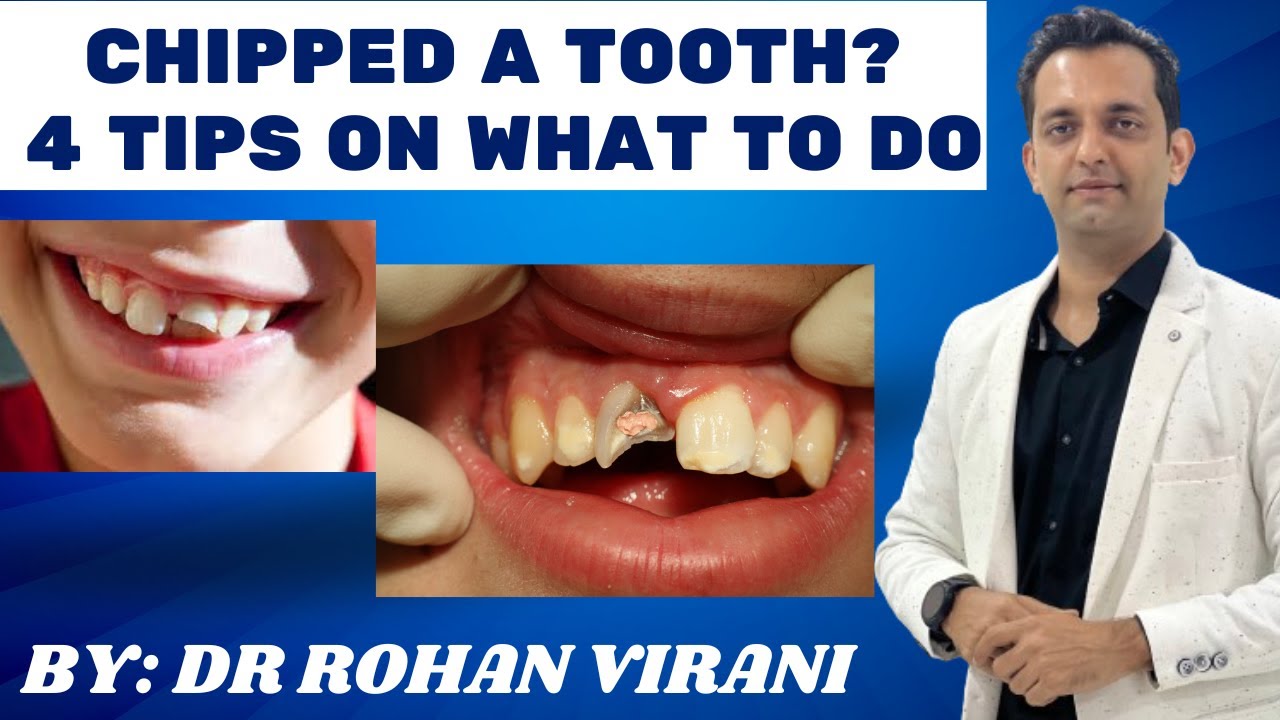 Chipped a Tooth? 4 Tips on What To Do - YouTube