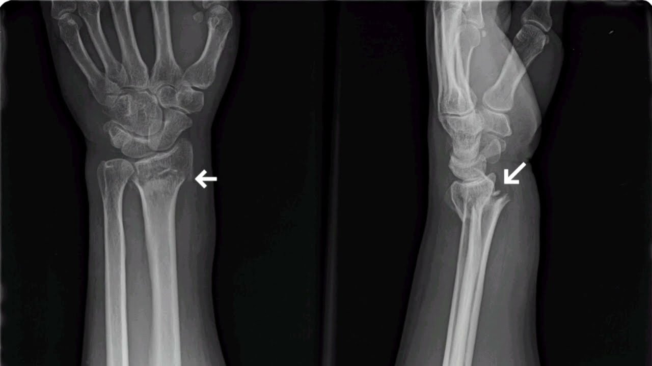 FRACTURA DE COLLES EN MUJER DE 52 AÑOS CORRECIÓN CON TRATAMIENTO ...