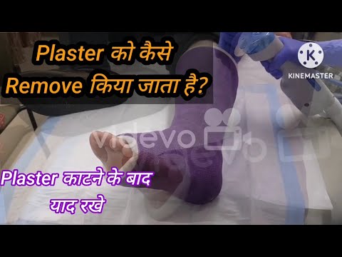 Plaster को कैसे काटे/Remove करे?POP Cast Remove - YouTube