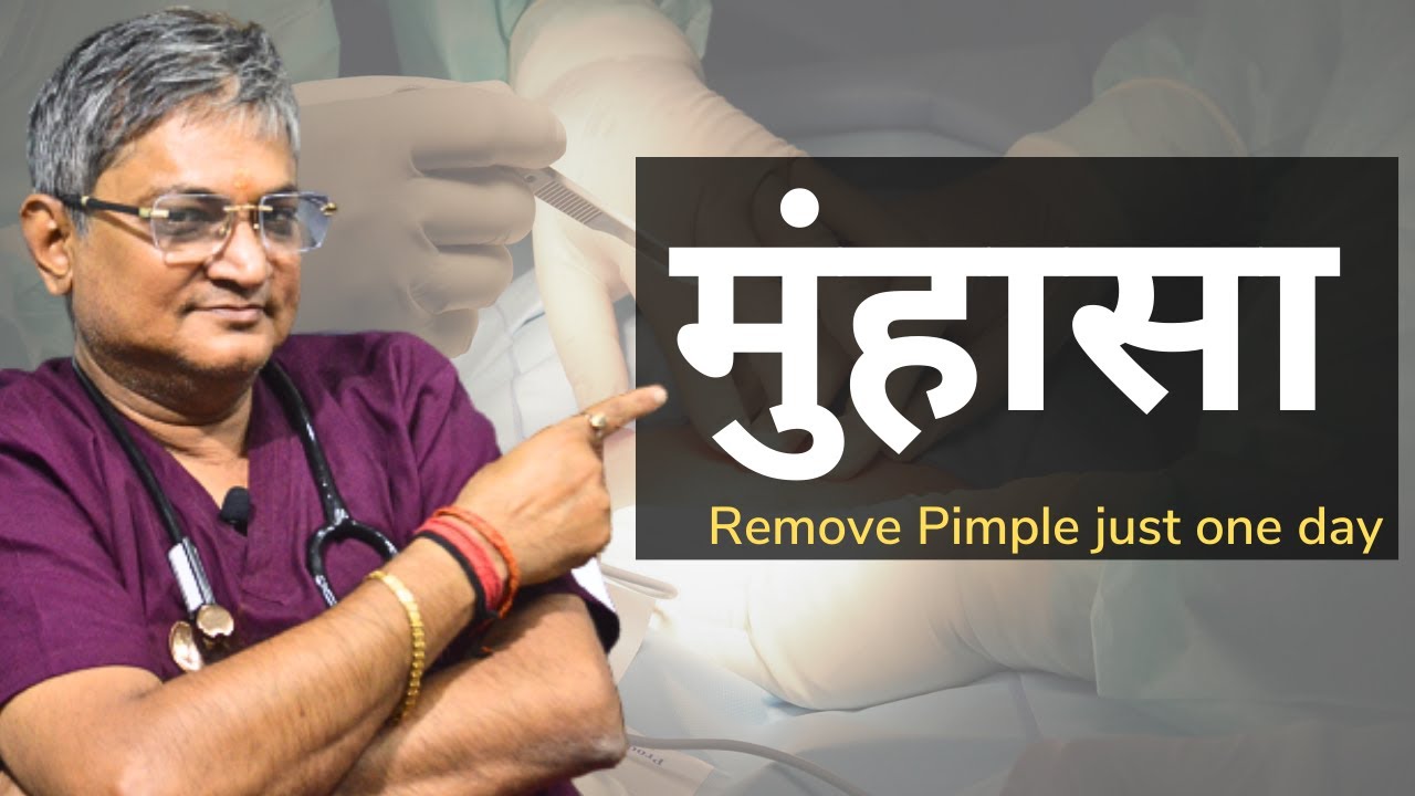Muhase का upchar - Pimple remove in a day - Unbelievable Acne Treatment ...