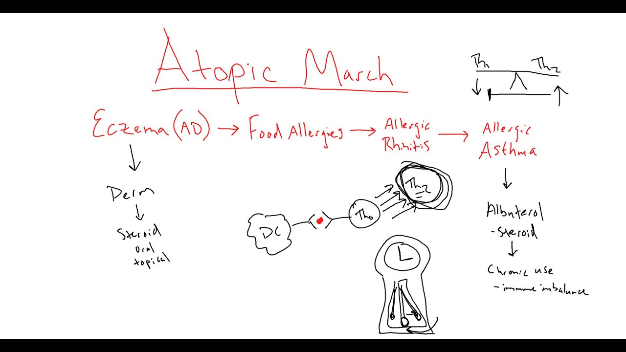Atopic March - what causes it and what can you do about it? - YouTube
