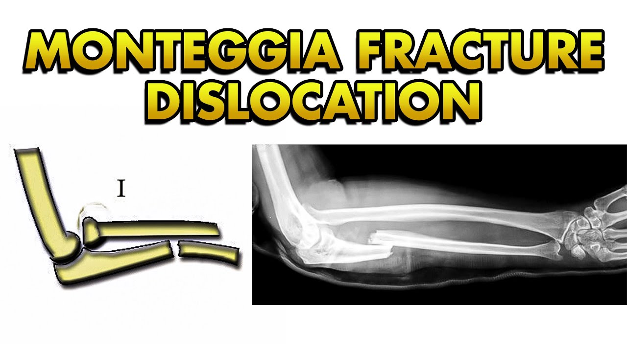 Monteggia Fracture Dislocation: Bado Classification, Treatment and ...
