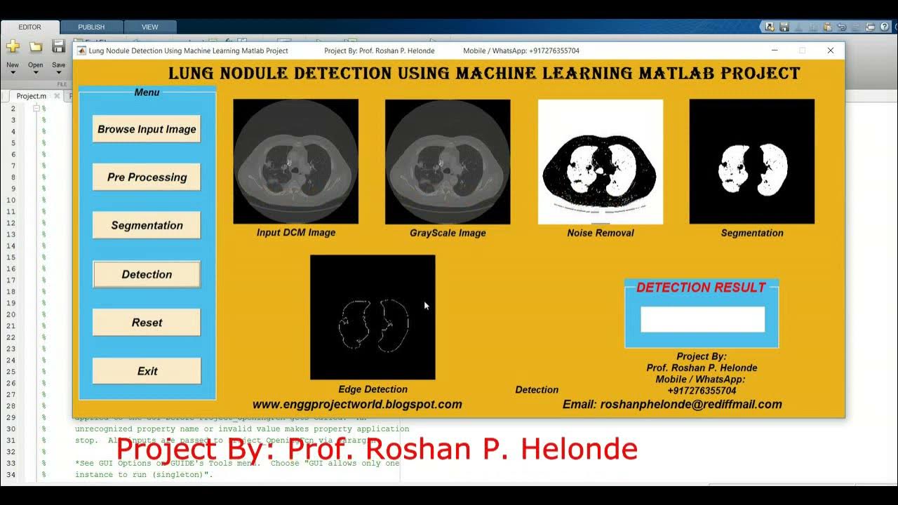 Lung Nodule Detection On Dicom Image Using Machine Learning | With ...