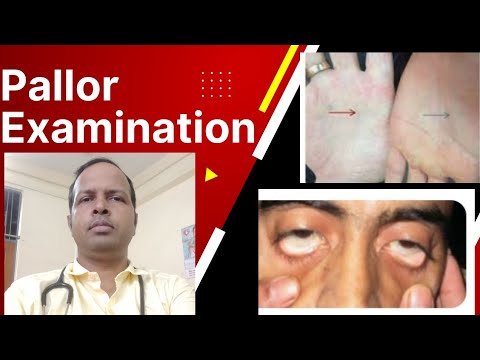 Pallor and its grading (General examination) in English #Pallor By Dr ...