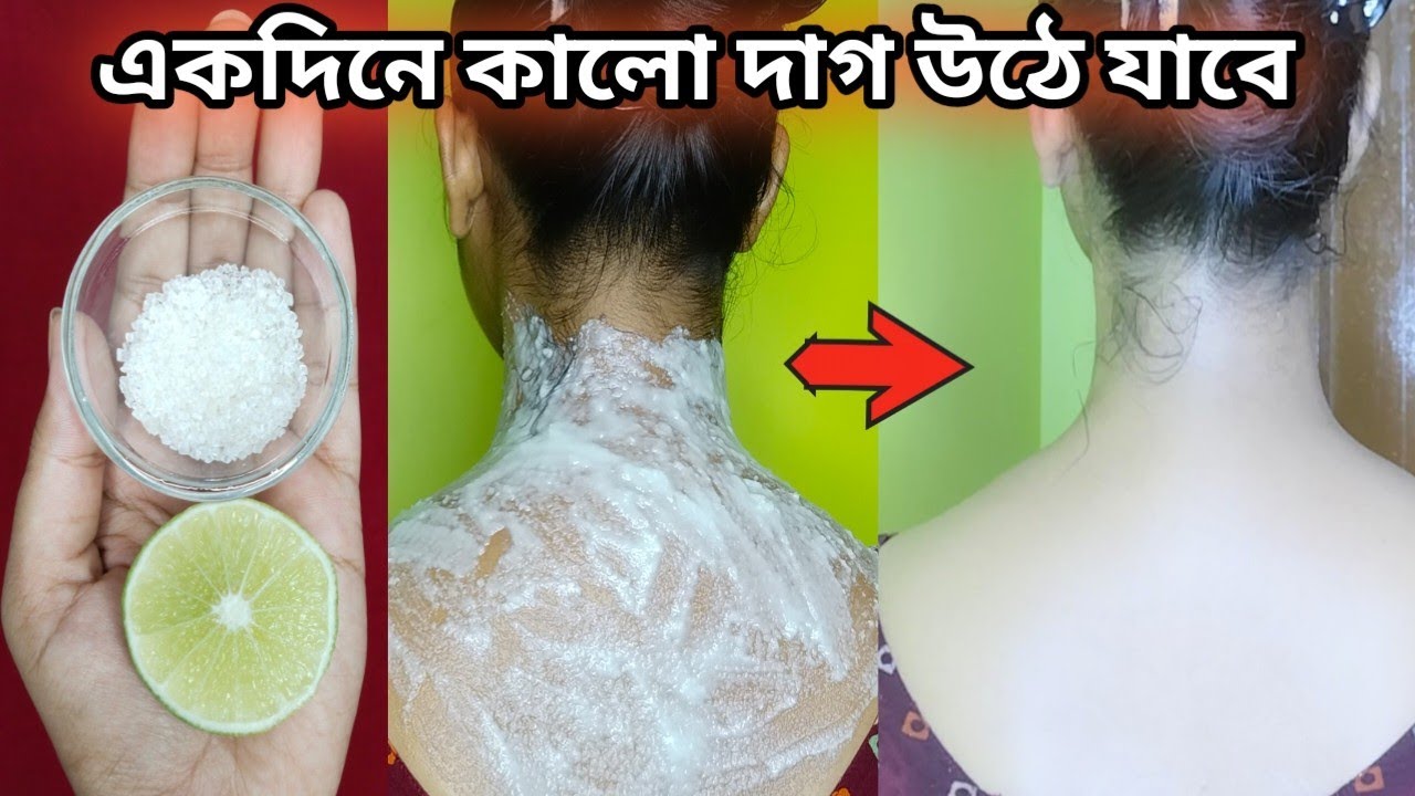 ১ দিনে : গলা ও ঘাড়ের জেদী কালো দাগ দূর হবে/gola o gharer kalo dag dur ...