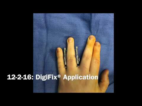 Traumatic PIP Flexion Contracture - YouTube
