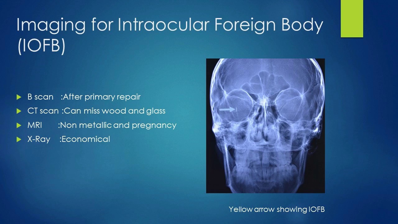 Metallic Intraocular foreign body removal-"Made easy with Rare Earth ...