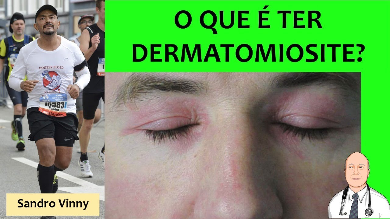 As experiências de quem tem dermatomiosite: do diagnóstico às ...