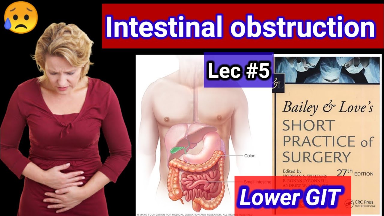 Lower GIT Surgery LEC #5 Adynamic obstruction.paralytic ileus,pseudo ...