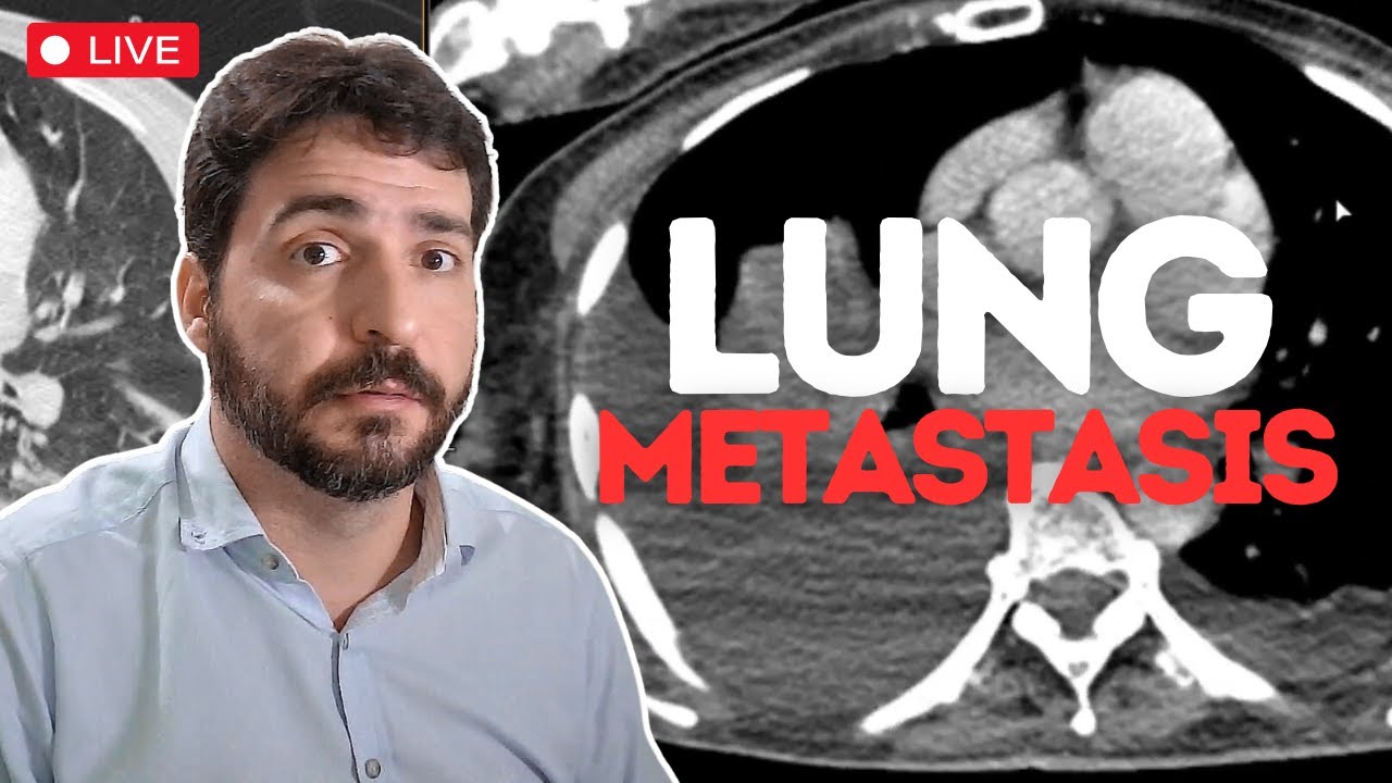 PULMONARY METASTASIS: Screening for Lung Lesions in an Advanced Cancer ...