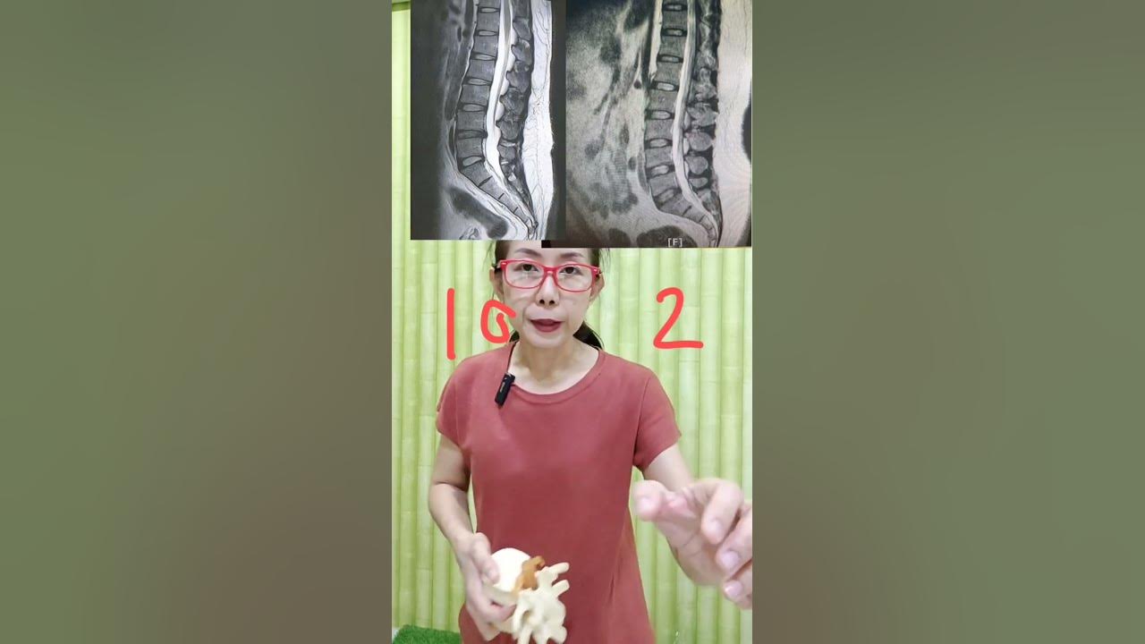 สอนให้รู้ ภาพ Mri หมอนรองกระดูกทับเส้นประสาท ปวดอะไรก็หายได้byกภขวัญ