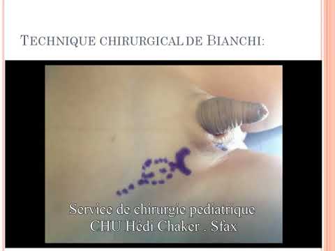 Incision de BIANCHI fini - YouTube