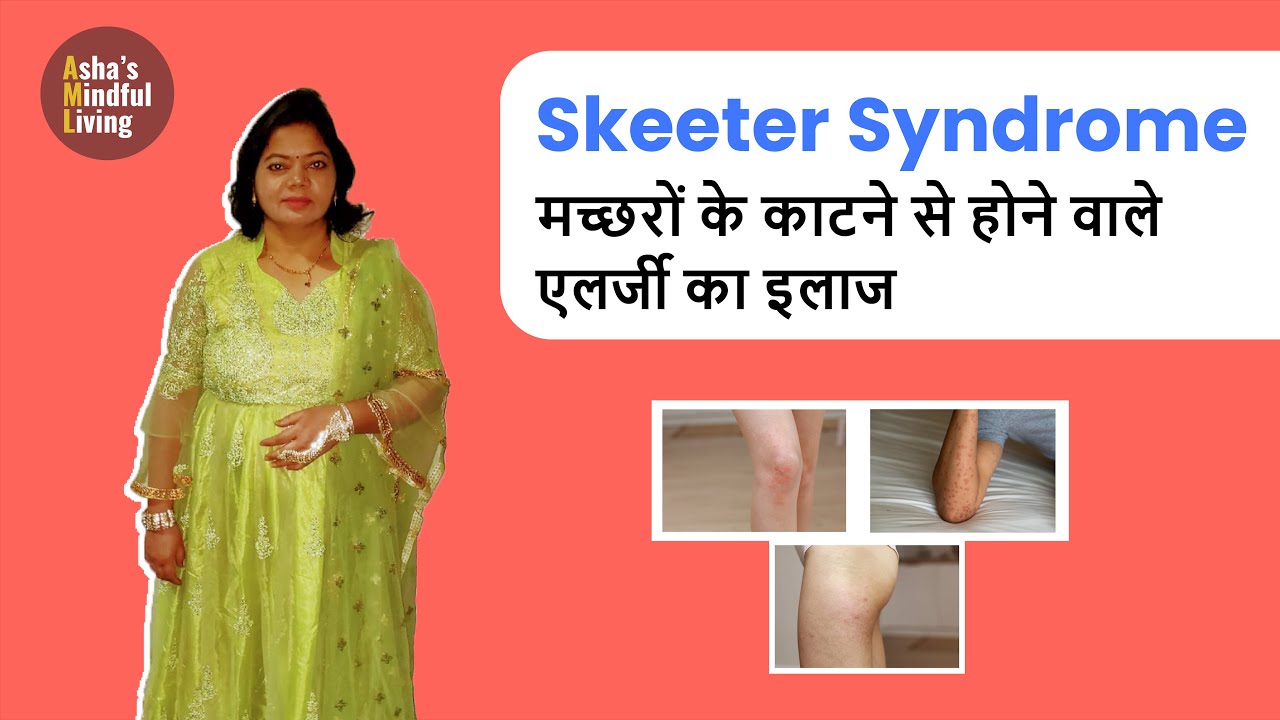 मच्छरों के काटने से होने वाले एलर्जी का इलाज | Skeeter Syndrome के बारे ...