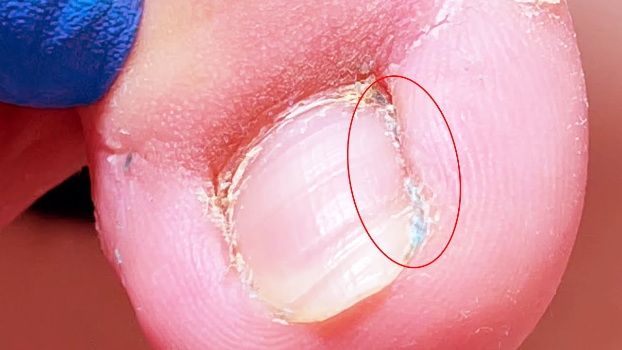 Super long nails cleared, too much dead skin causing discoloration of ...