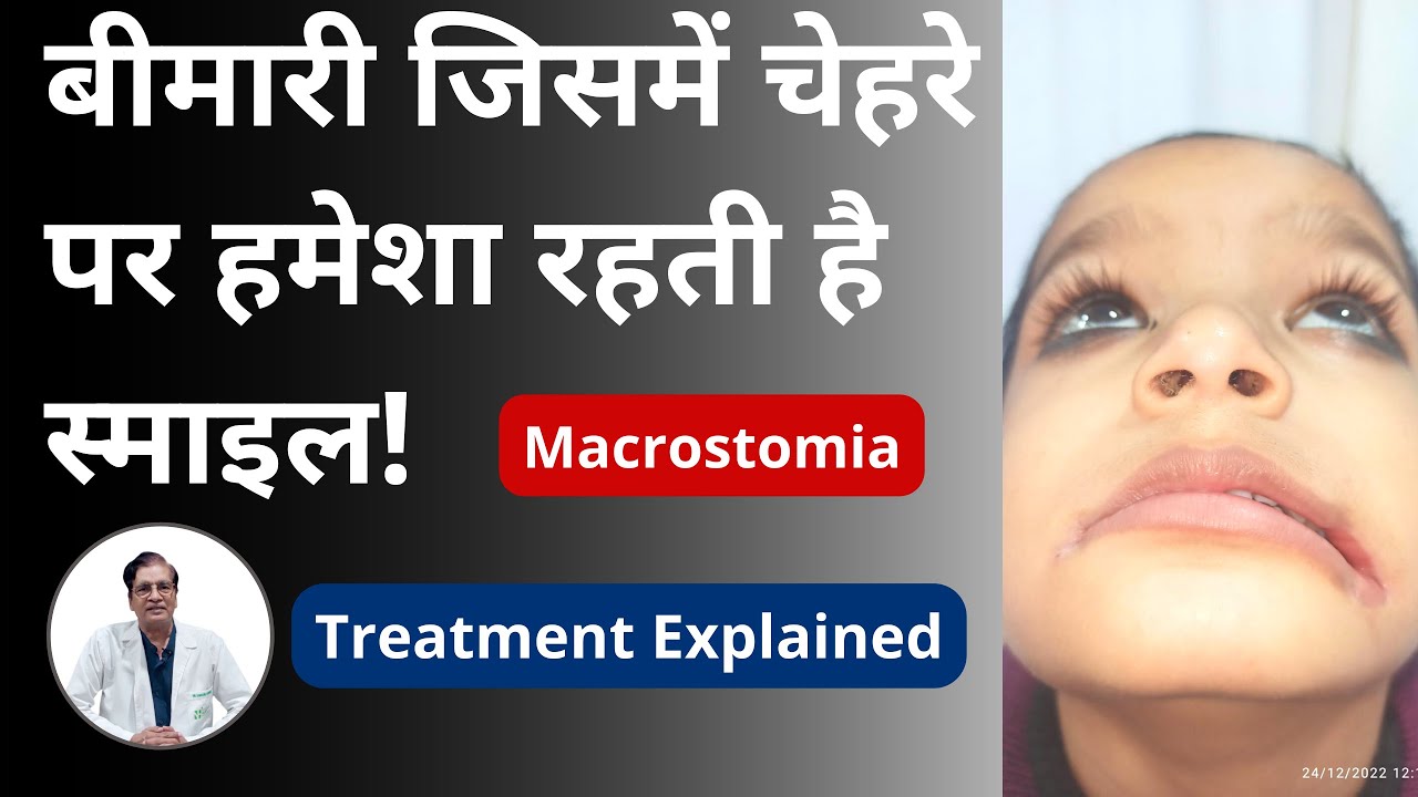 Macrostomia - Unilateral or Bilateral | Treatment in Hindi | Dr. Karoon ...