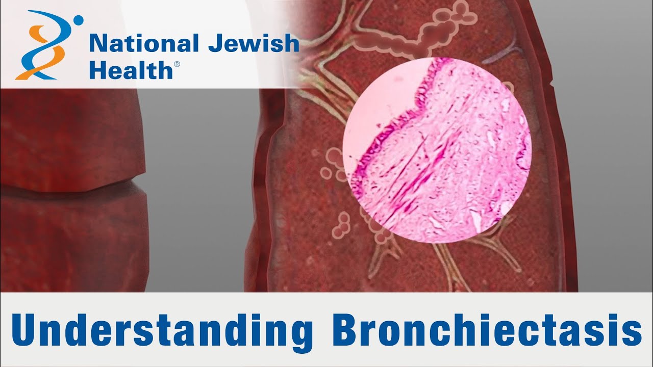 Understanding Bronchiectasis: Overview and Clinical Features - YouTube